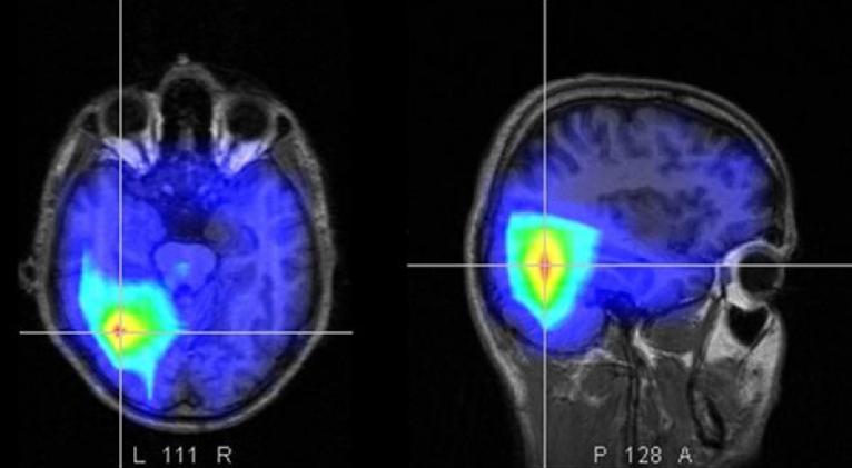 Diabetes Mellitus Y Su Relación Con La Enfermedad Cerebrovascular Cuba Si